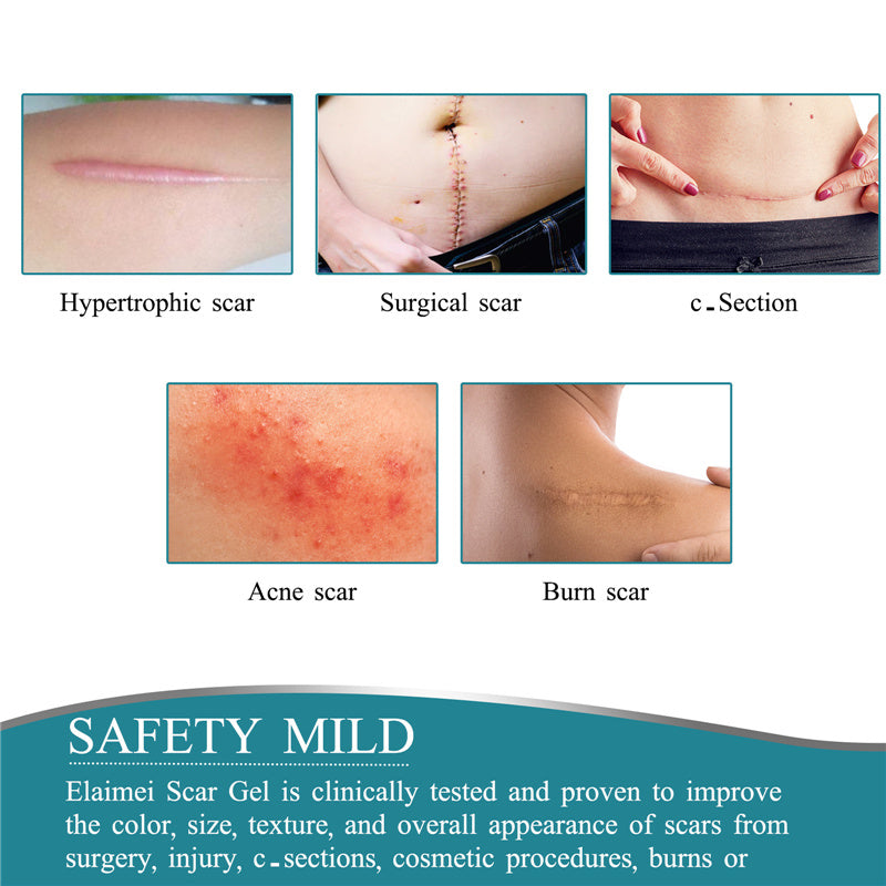 Silicone Scar Sheets Scar Removal Tapes Strips – Wise Living NZ